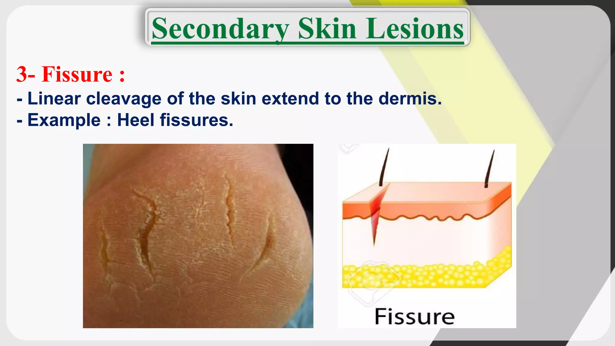 Dermatology (terminology of skin lesions) | PDF