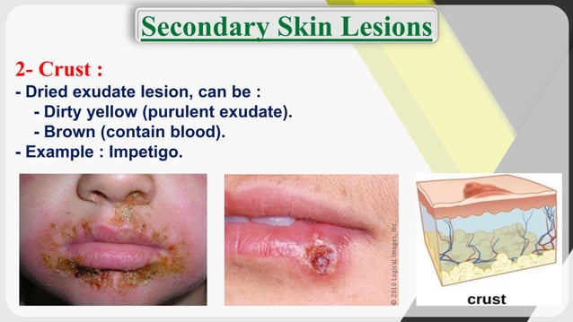 Dermatology (terminology of skin lesions) | PDF | Skin and Dermatology ...