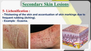 Dermatology (terminology of skin lesions) | PDF