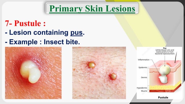 Dermatology (terminology of skin lesions) | PDF | Skin and Dermatology ...