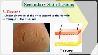 Fissure Skin Lesion