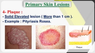 Plaque Skin Lesion