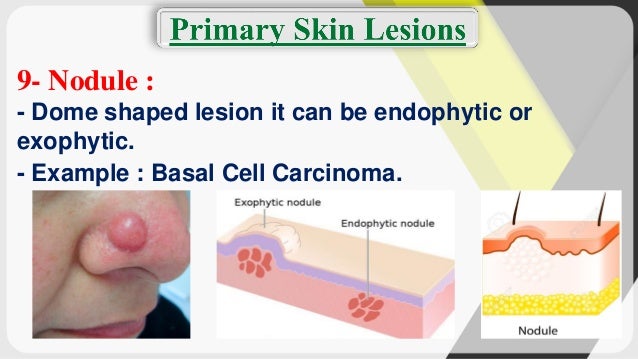Dermatology (terminology of skin lesions)
