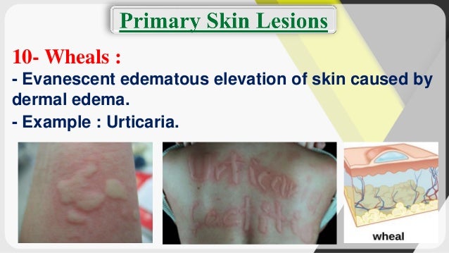 Dermatology (terminology of skin lesions)