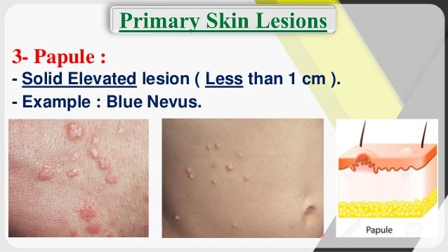 Dermatology Terminology Of Skin Lesions Compare Usmle Skin Lesion