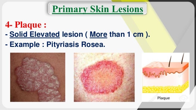 Dermatology (terminology of skin lesions)