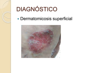 Dermatomicosis superficiales | PPTX