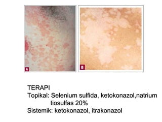 Dermatomikosis | PPT