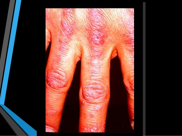 Dermatomiosite polimiosite