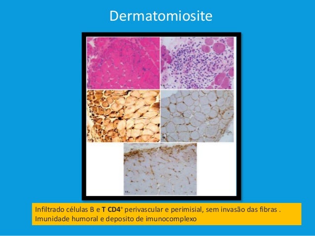 Dermatomiosite polimiosite 19