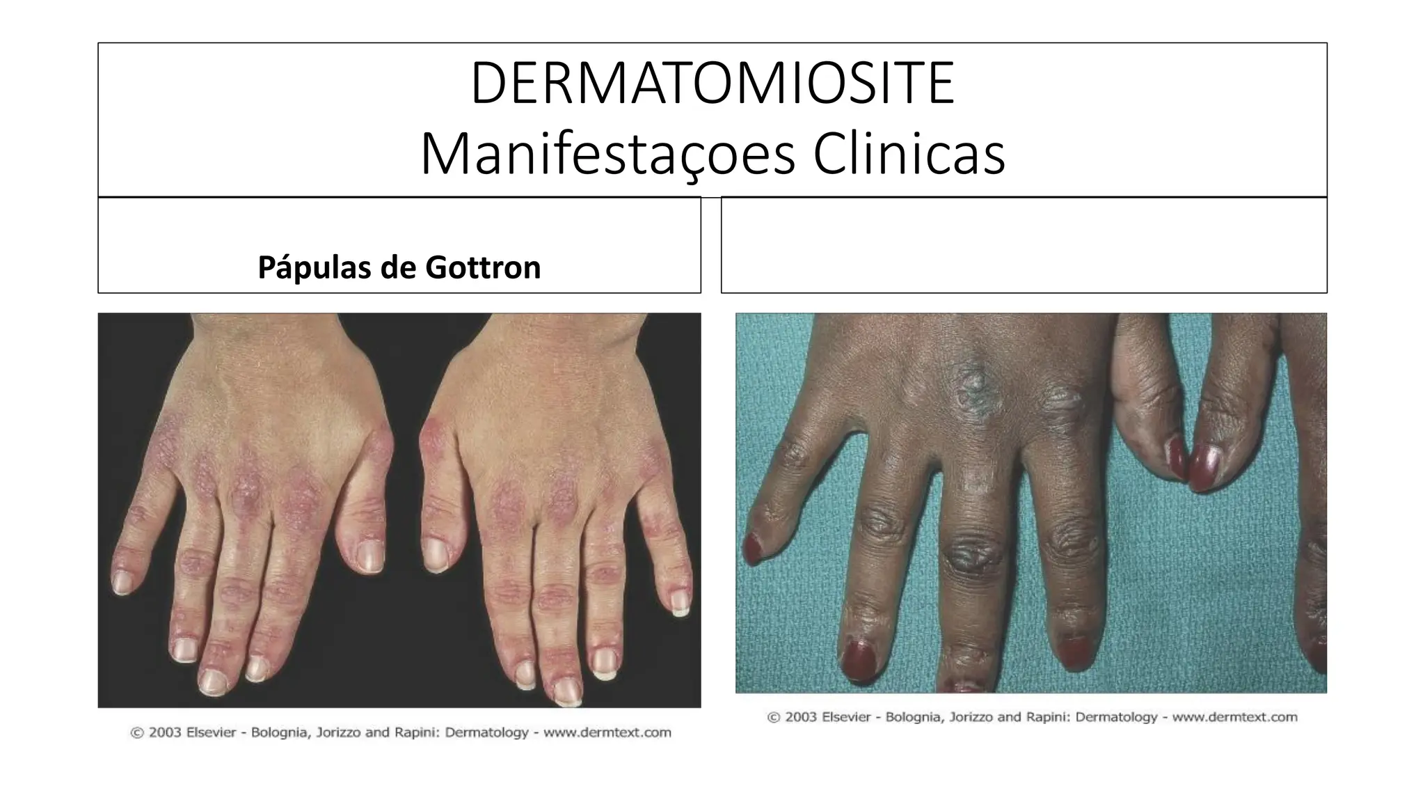 DERMATOMIOSITE.Dermatologia.Patol2021.pdf