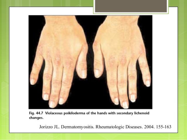 Poikiloderma Dermatomyositis