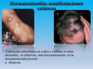Dermatomiositis.pptx