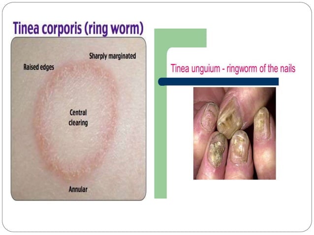 Dermatomycosis | PPTX | Skin and Dermatology | Diseases and Conditions