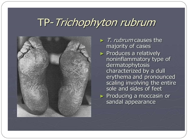 Dermatomycosis | PPTX | Skin and Dermatology | Diseases and Conditions