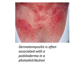 Poikiloderma Dermatomyositis