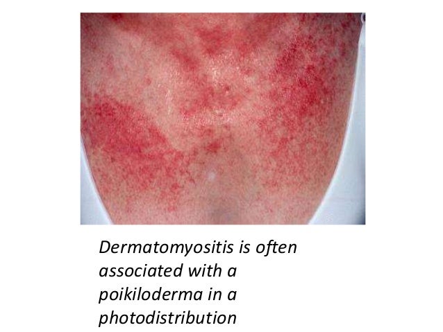 Dermatomyositis