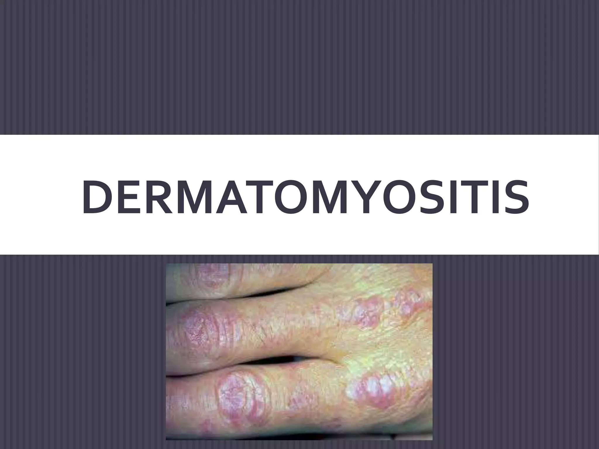 Dermatomyositis | PPTX