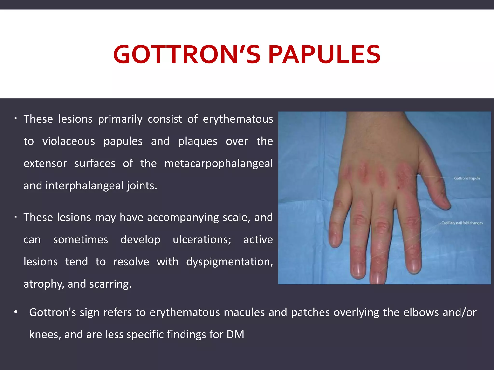 Dermatomyositis | PPTX