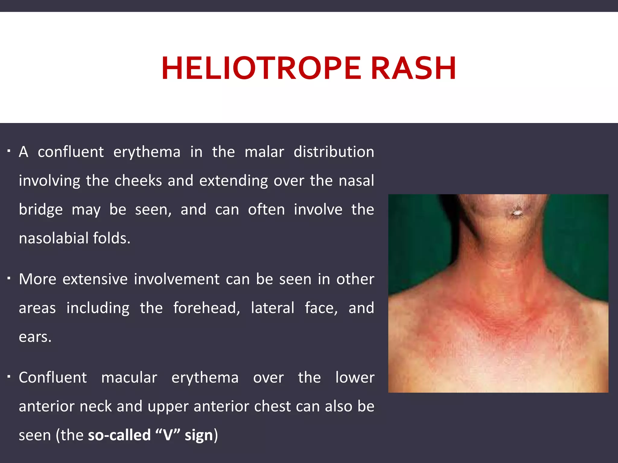 Dermatomyositis | PPTX