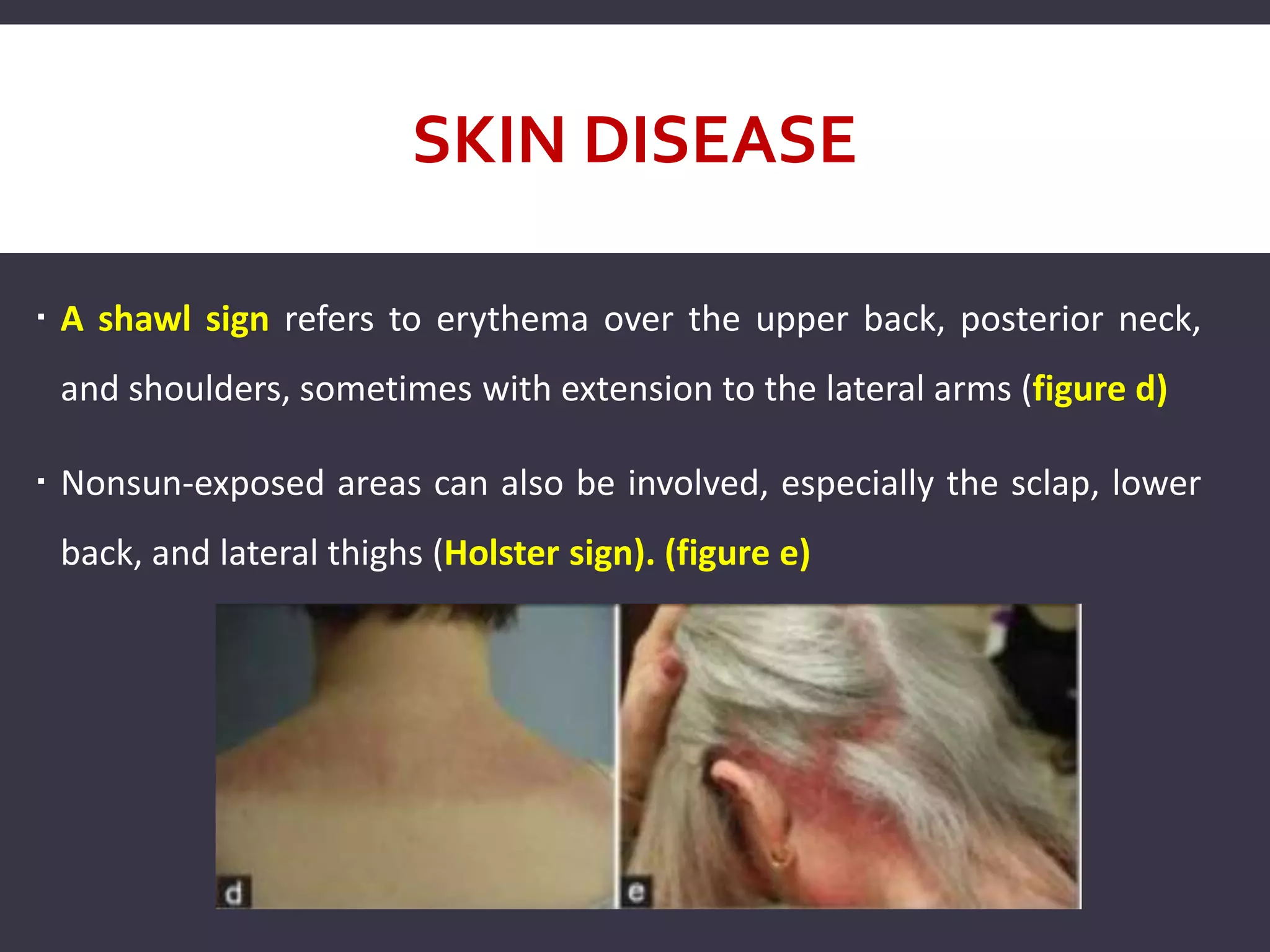 Dermatomyositis | PPTX