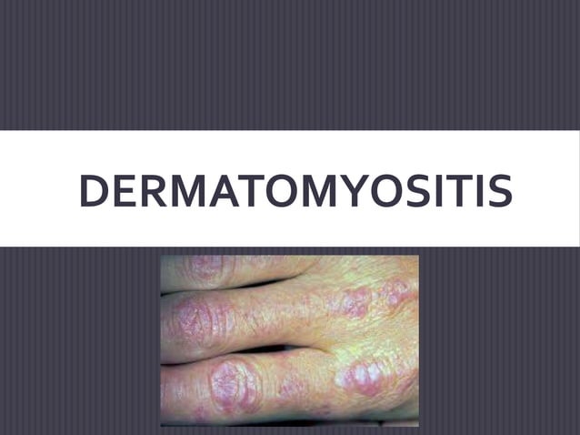 Dermatomyositis | PPTX