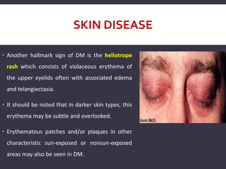 Heliotrope Rash On Eyes