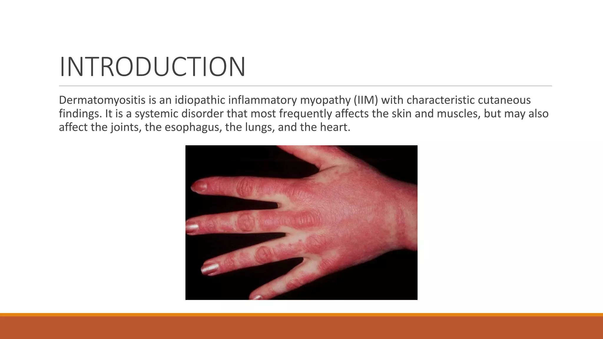 Dermatomyositis | PPTX