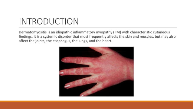 Dermatomyositis | PPTX
