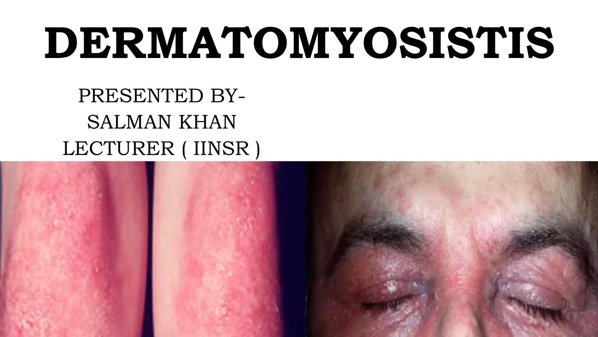DERMATOMYOSITIS.pptx