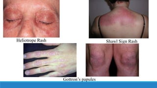DERMATOMYOSITIS.pdf