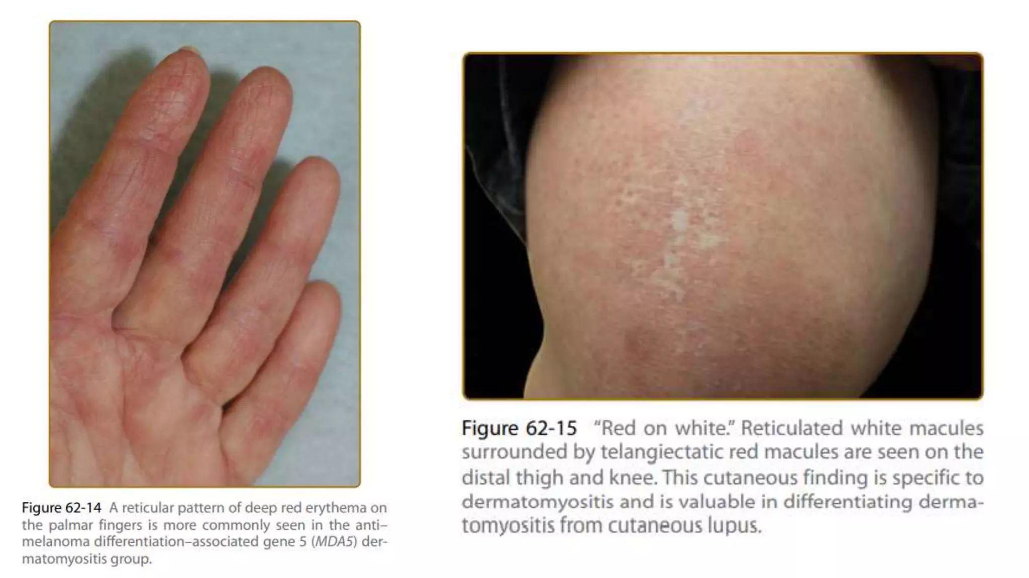 Dermatomyositis diskusi div adi alergi.pptx | Skin and Dermatology ...