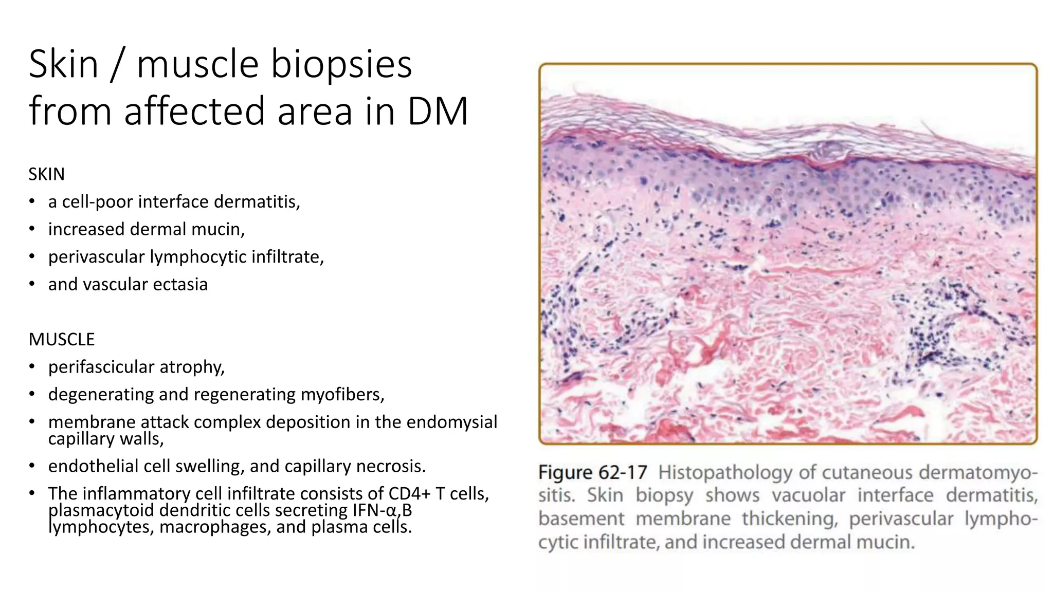 Dermatomyositis diskusi div adi alergi.pptx | Skin and Dermatology ...