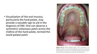 Dermatomyositis diskusi div adi alergi.pptx