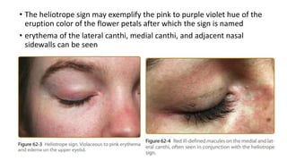 Dermatomyositis diskusi div adi alergi.pptx