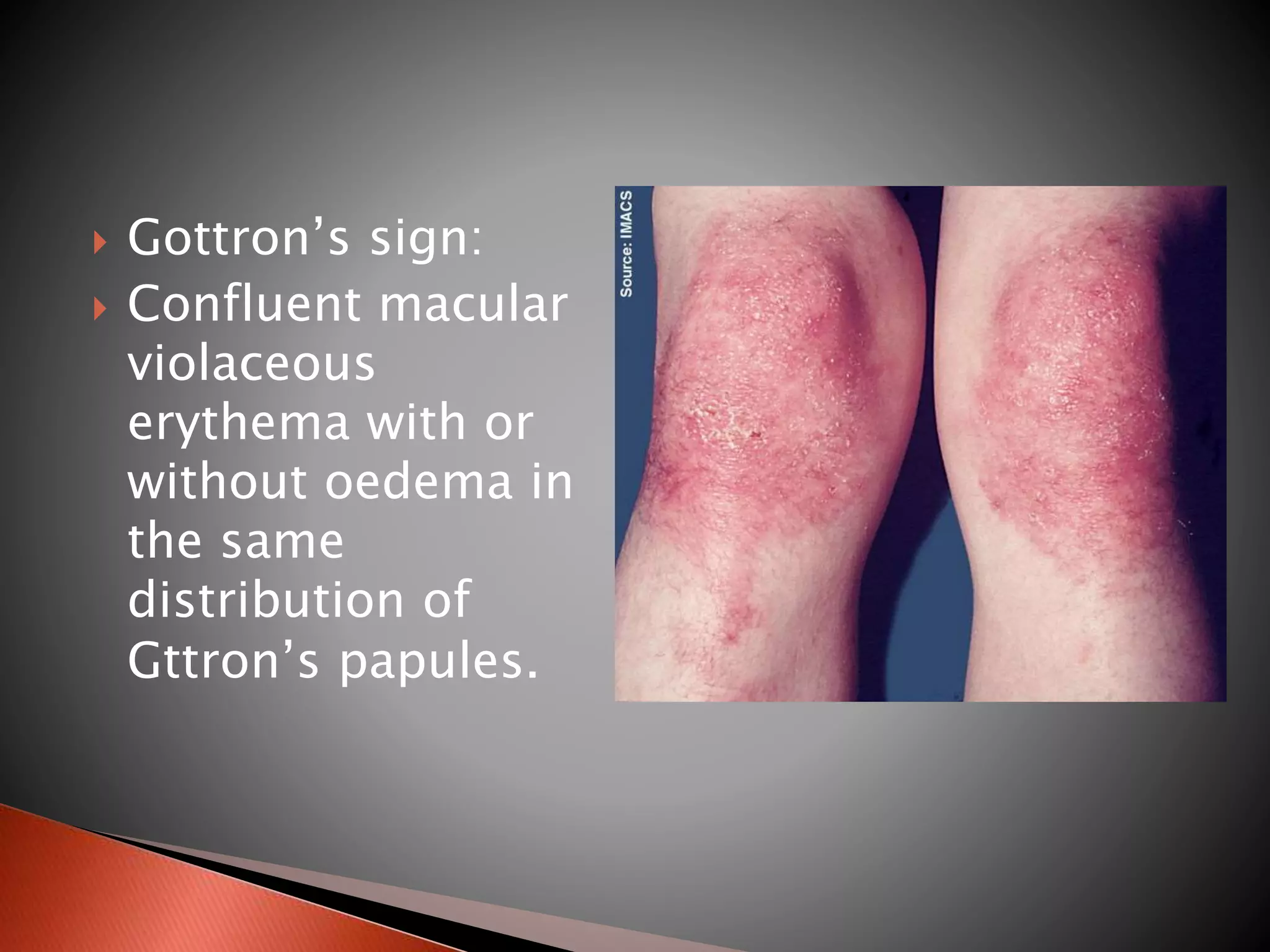 Dermatomyositis Dr. Saad Raheem Abed | PPTX | Skin and Dermatology ...