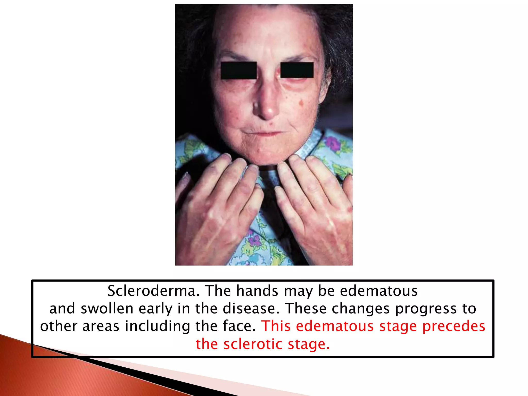 Dermatomyositis Dr. Saad Raheem Abed | PPTX | Skin and Dermatology ...