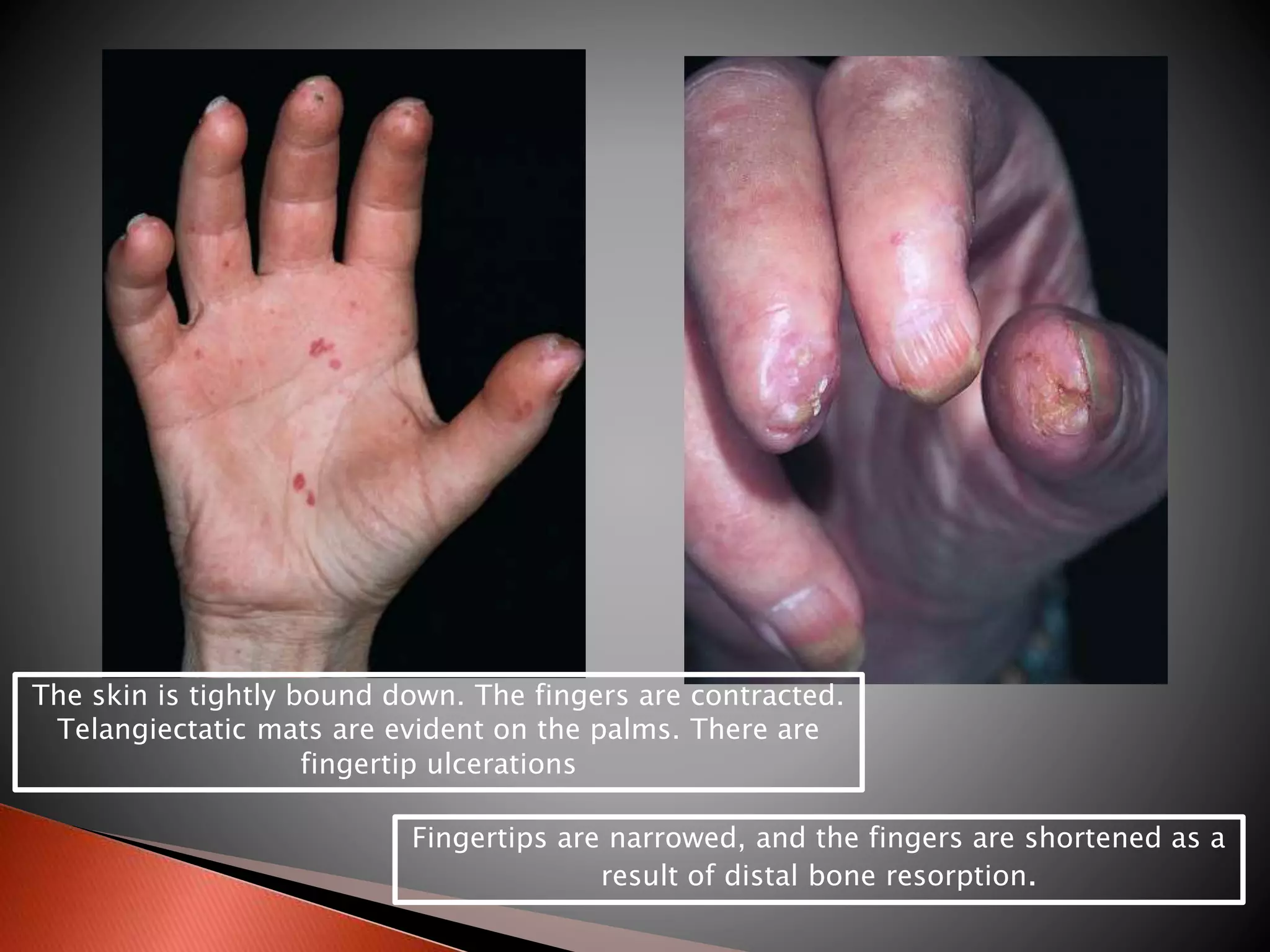 Dermatomyositis Dr. Saad Raheem Abed | PPTX | Skin and Dermatology ...