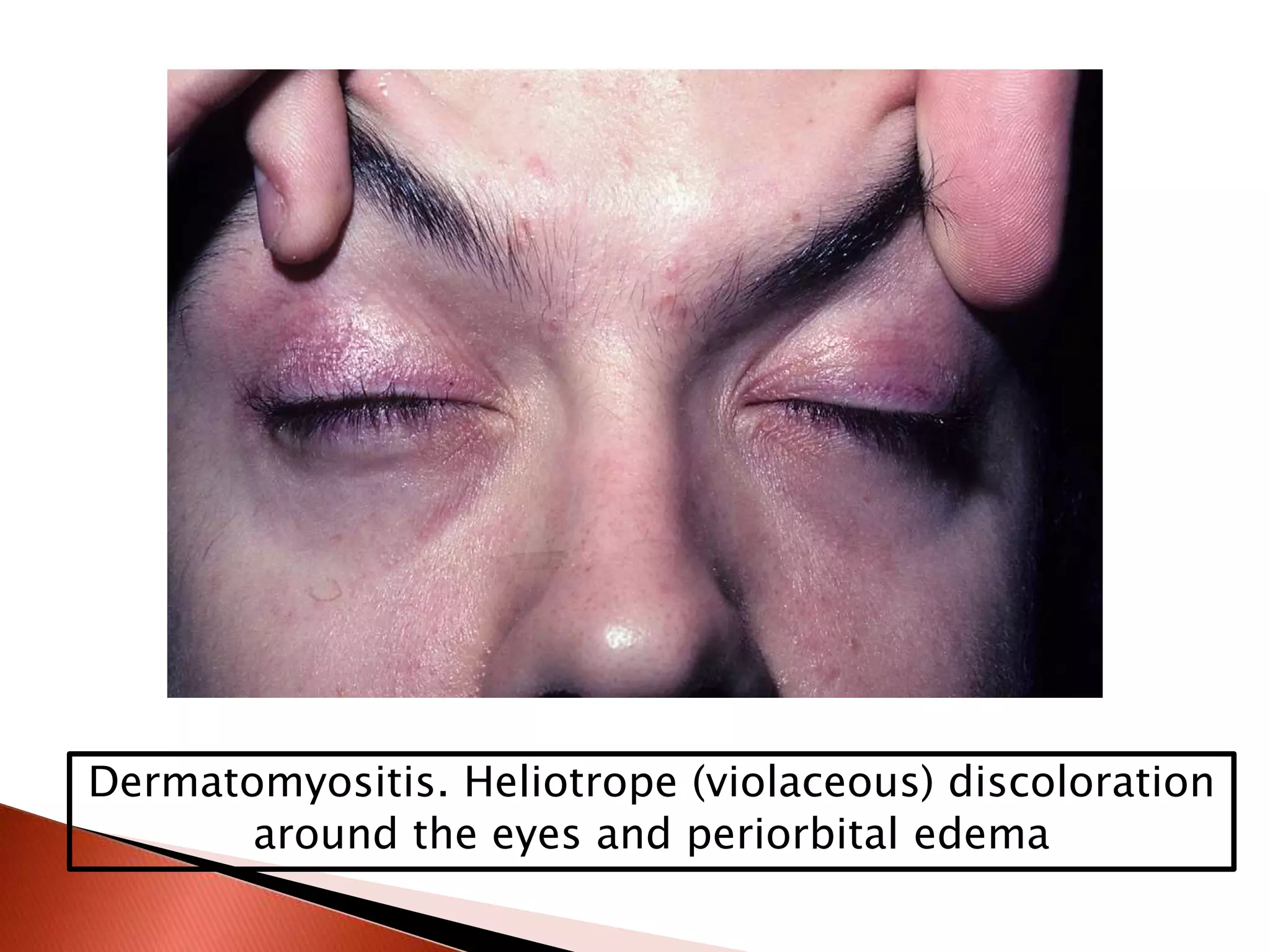 Dermatomyositis Dr. Saad Raheem Abed | PPTX | Skin and Dermatology ...