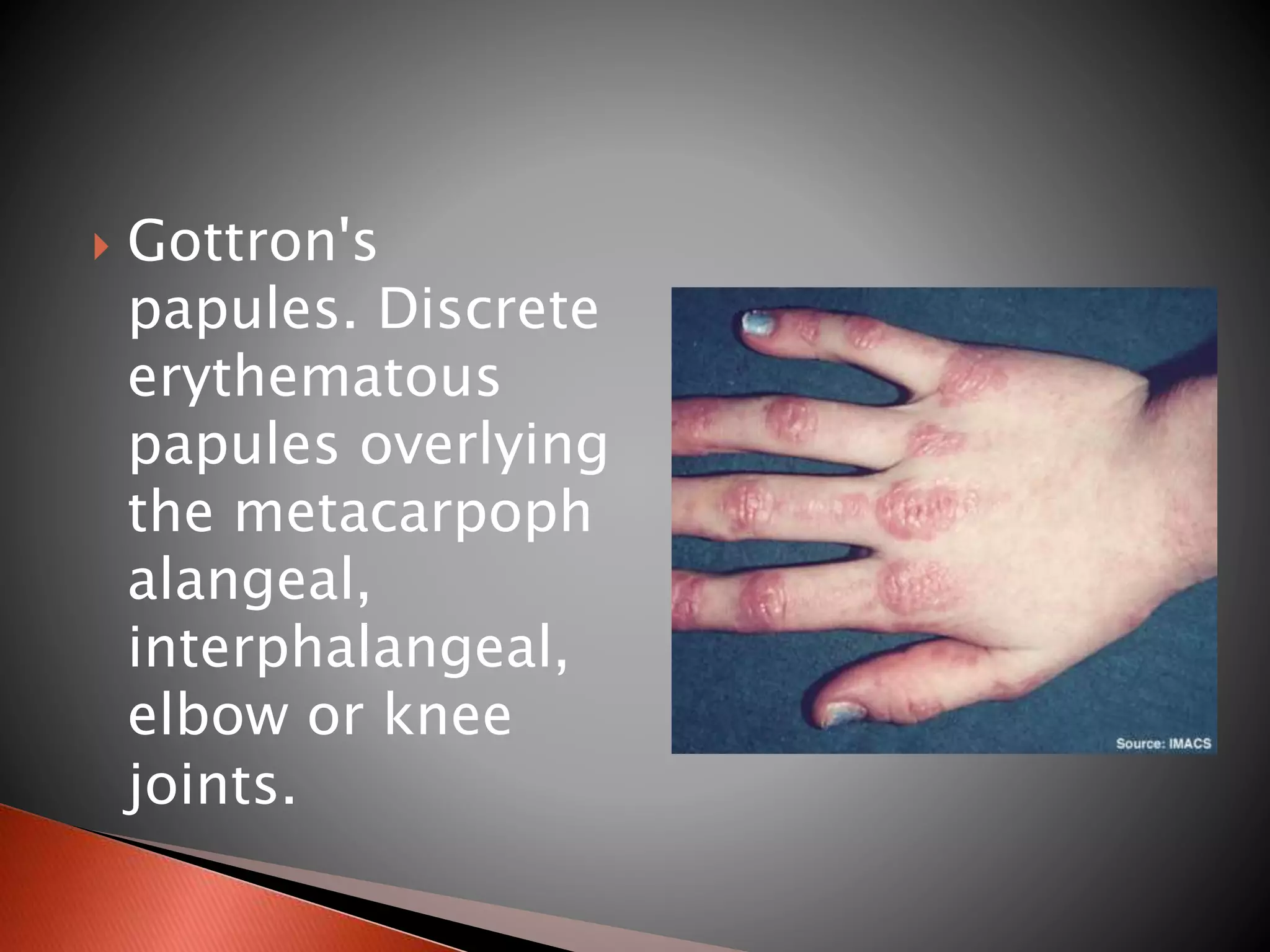 Dermatomyositis Dr. Saad Raheem Abed | PPTX | Skin and Dermatology ...