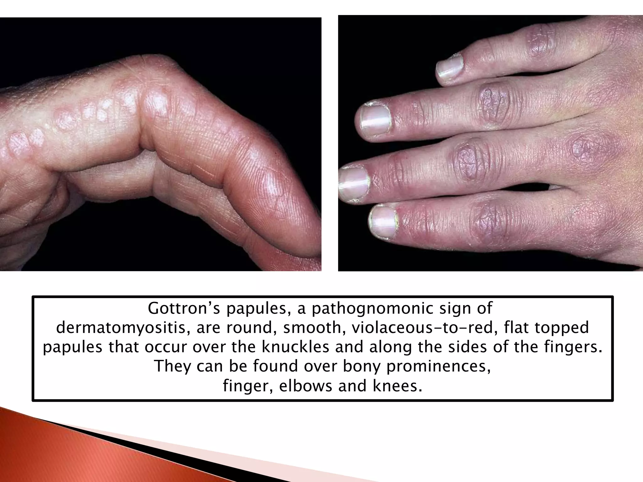 Dermatomyositis Dr. Saad Raheem Abed | PPTX