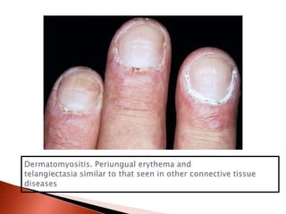 Periungual Erythema