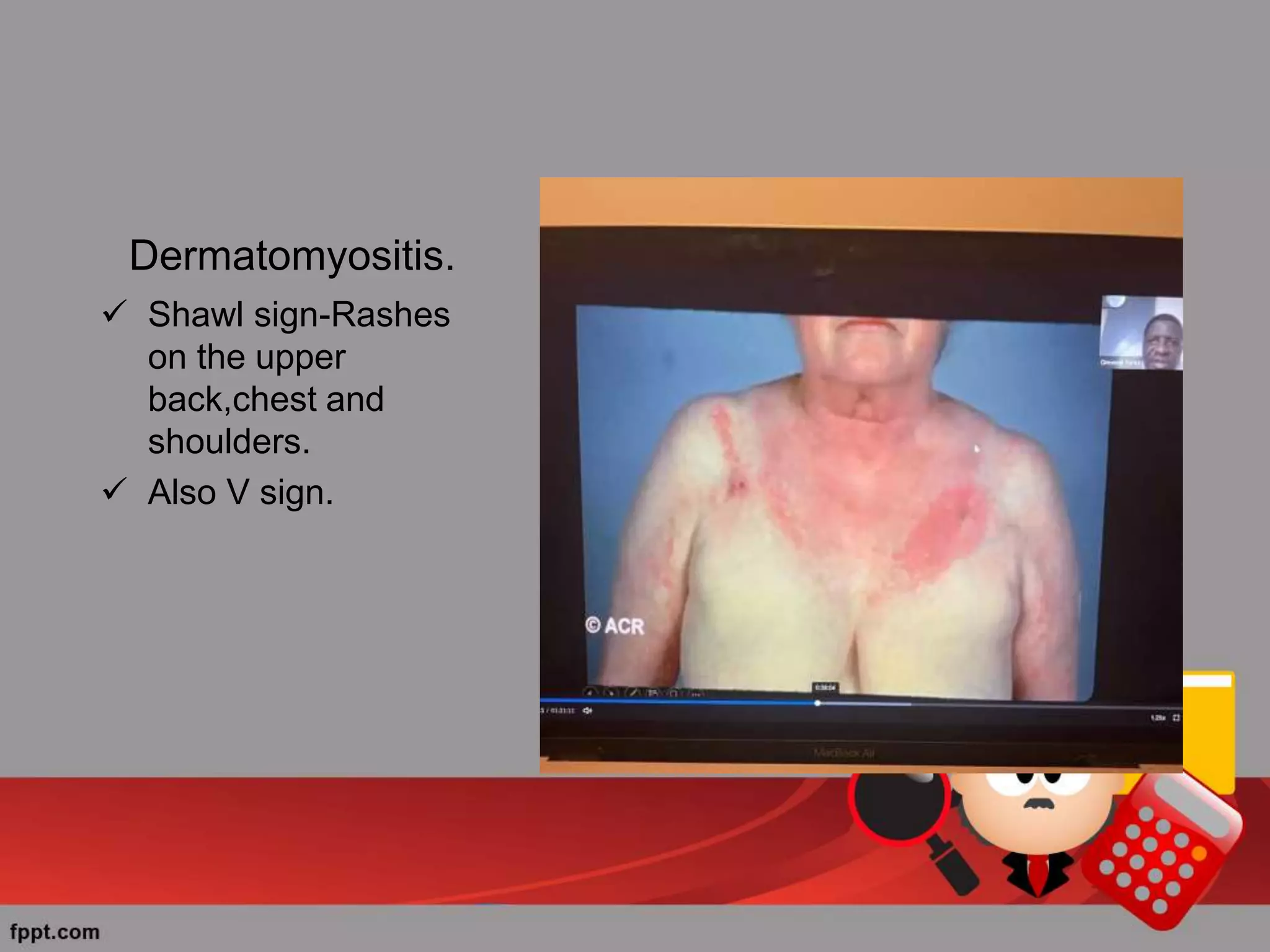 Dermatomyositis images 1.pptx