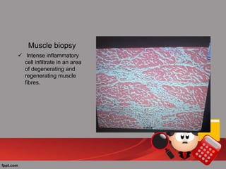 Dermatomyositis images 1.pptx