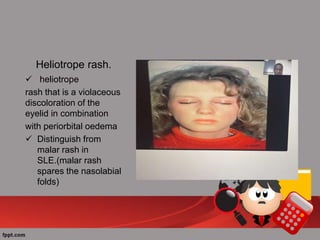 Dermatomyositis images 1.pptx