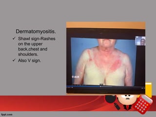 Dermatomyositis images 1.pptx