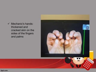 Dermatomyositis images 1.pptx