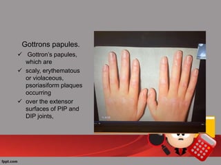 Dermatomyositis images 1.pptx