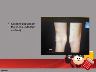 Dermatomyositis images 1.pptx