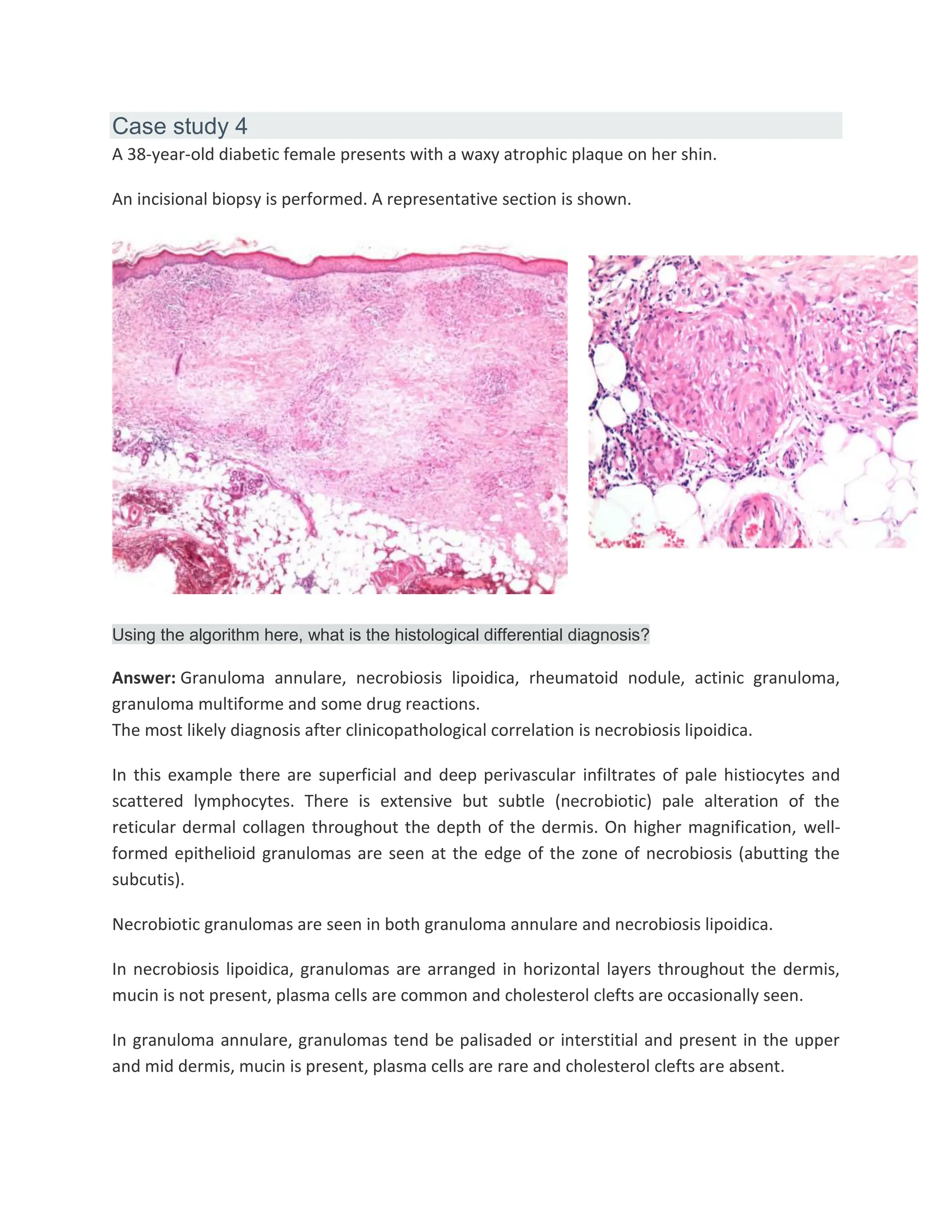 dermatopathology granulomatous inflammation.pdf
